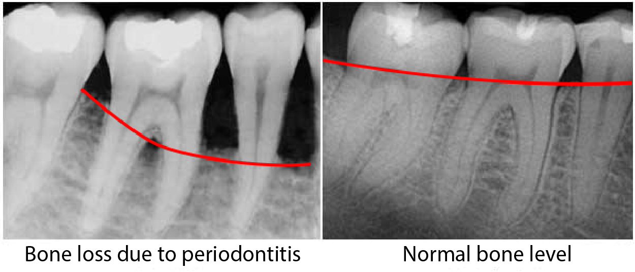 Negative effects of periodontal disease – Nha Khoa Numberone
